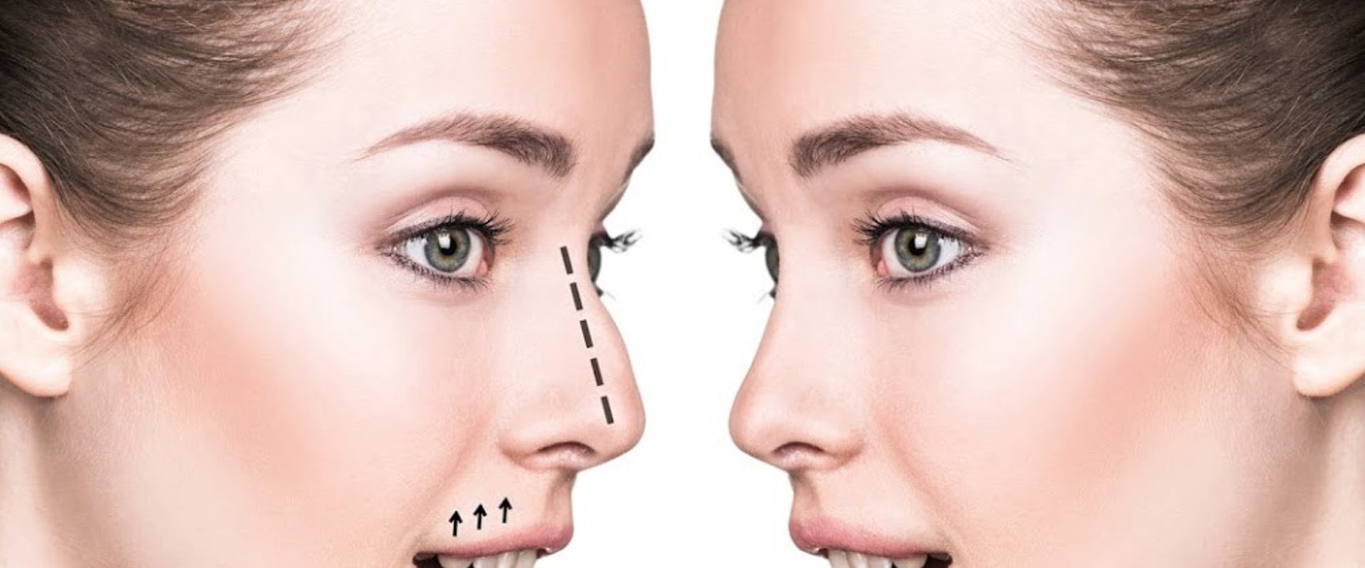 Get Expert Rhinoplasty From The Top Beverly Hills CA Nose Surgeon For ...