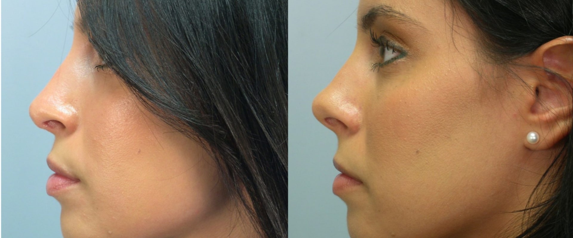 The Ins and Outs of Rhinoplasty: What You Need to Know